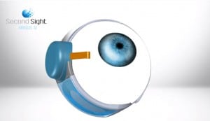 World's First Bionic Eye: Most Sophisticated Prosthetic Ever Developed