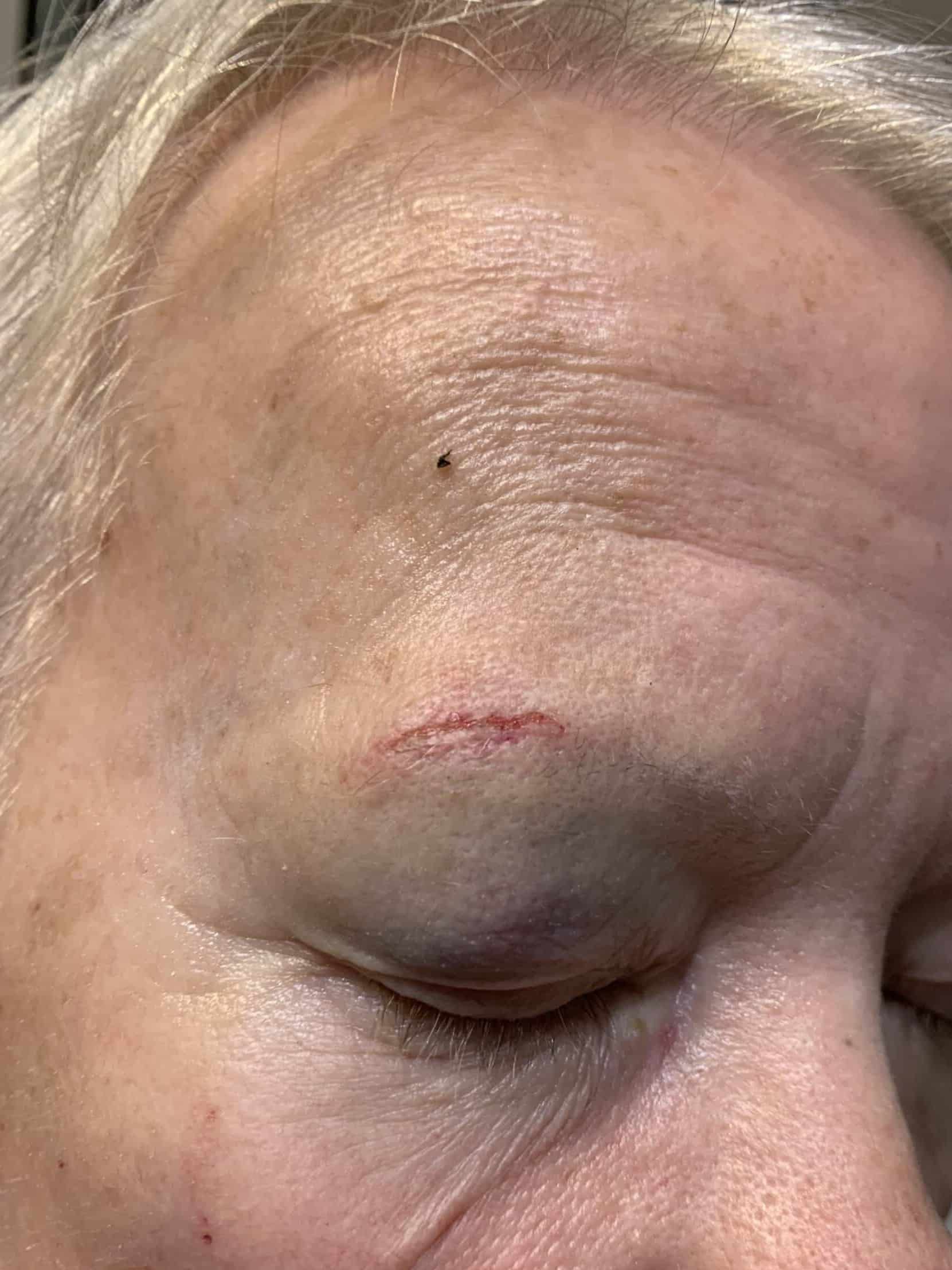 Understanding The Long-Term Impact Of Car Accident Face Injuries | Bit ...